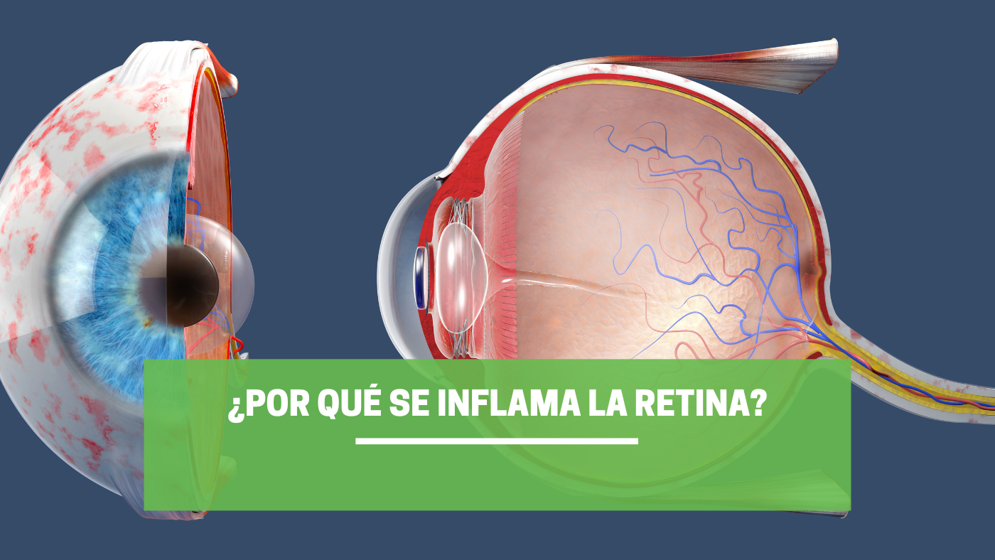 ¿Por Qué se Inflama la Retina? Explicación de sus Causas
